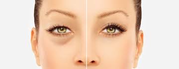 Blefaroplastia (Cirugia de Parpados y ojeras) en cuenca